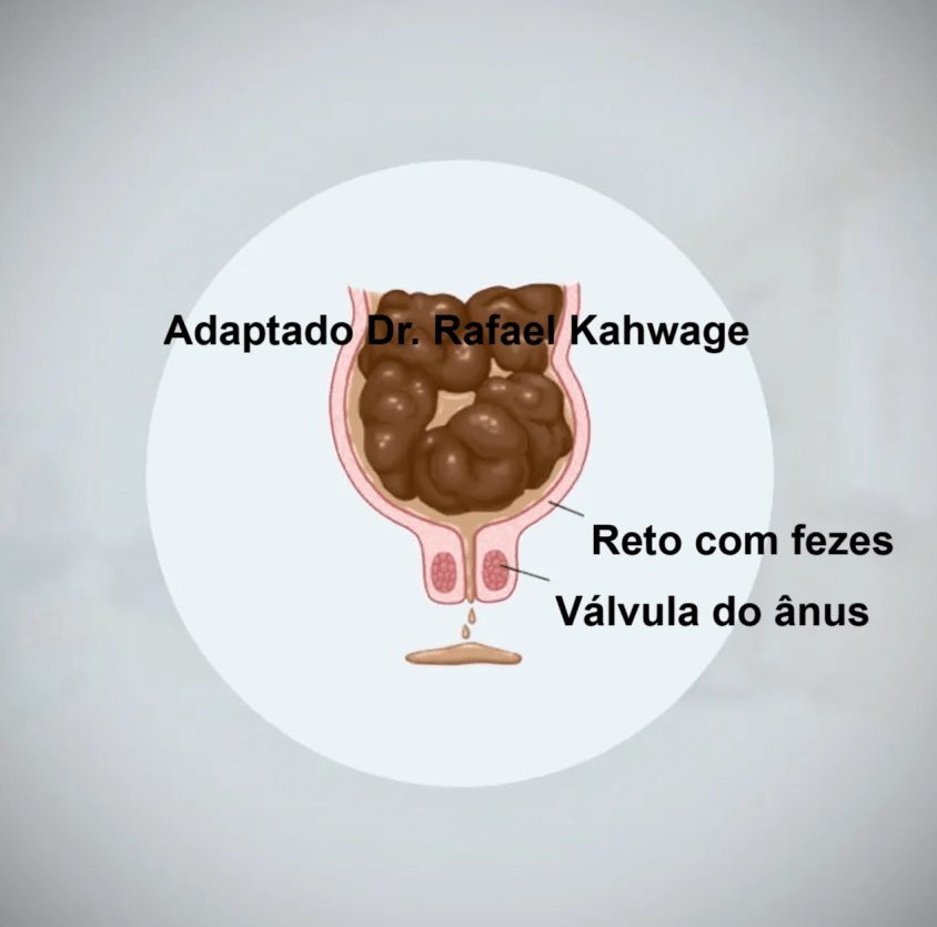 Entendendo a Incontinência Fecal: Causas, Tratamentos e Qualidade de ...